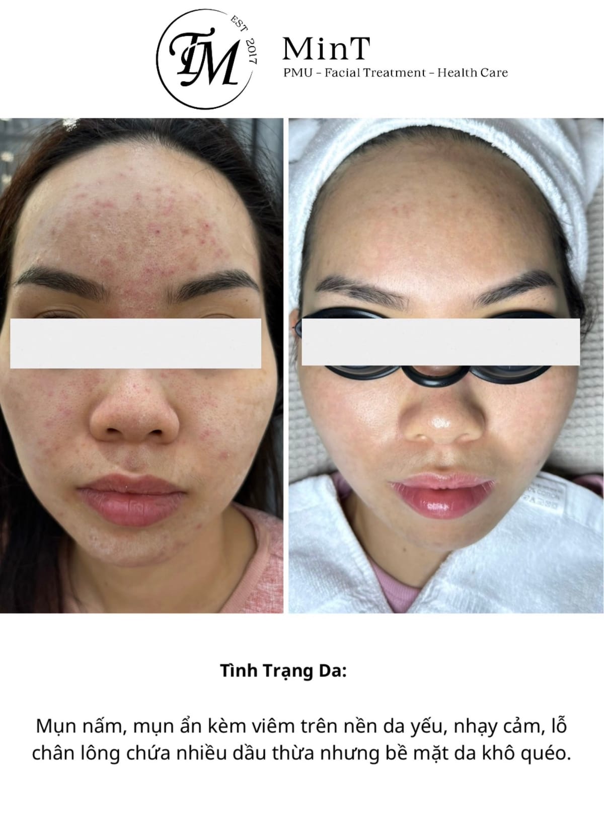 Điều Trị Mụn - MinT Foundation